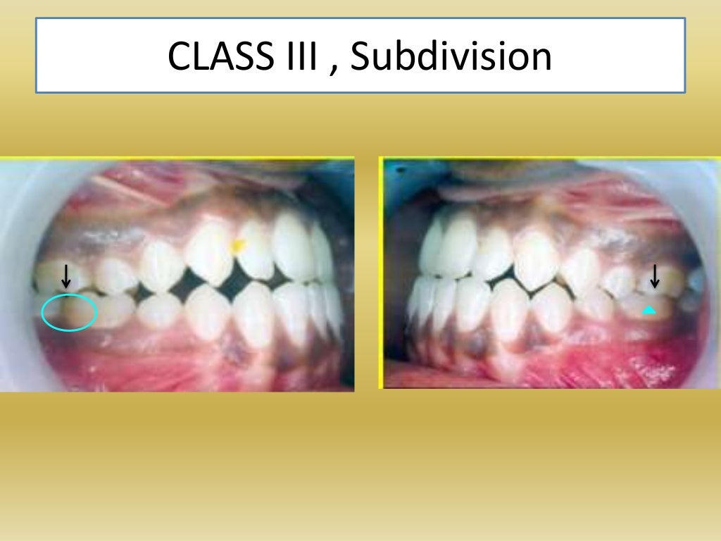 Angle's classification of malocclusion
