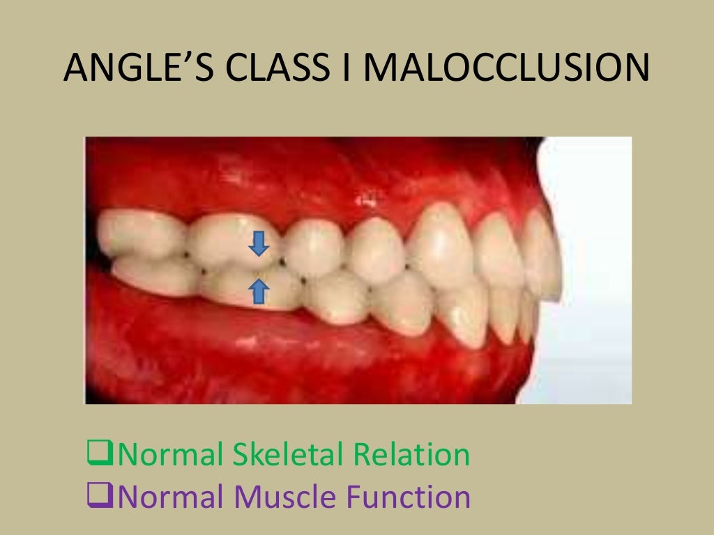 Angle's classification of malocclusion