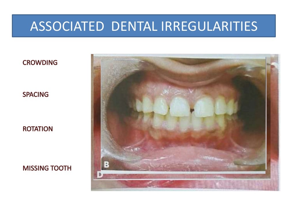 Angle's classification of malocclusion