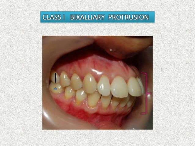 Angle's classification of malocclusion