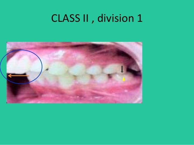 Angle's classification of malocclusion