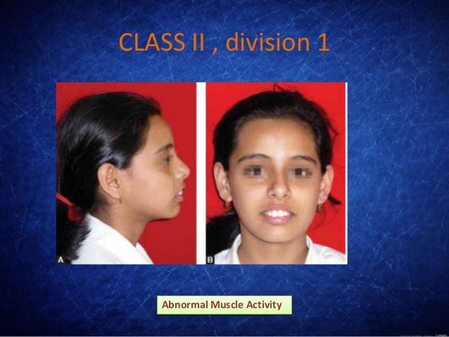 Angle's classification of malocclusion