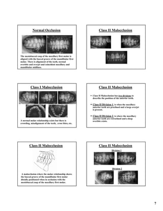 Angle's classification of malocclusion | PDF