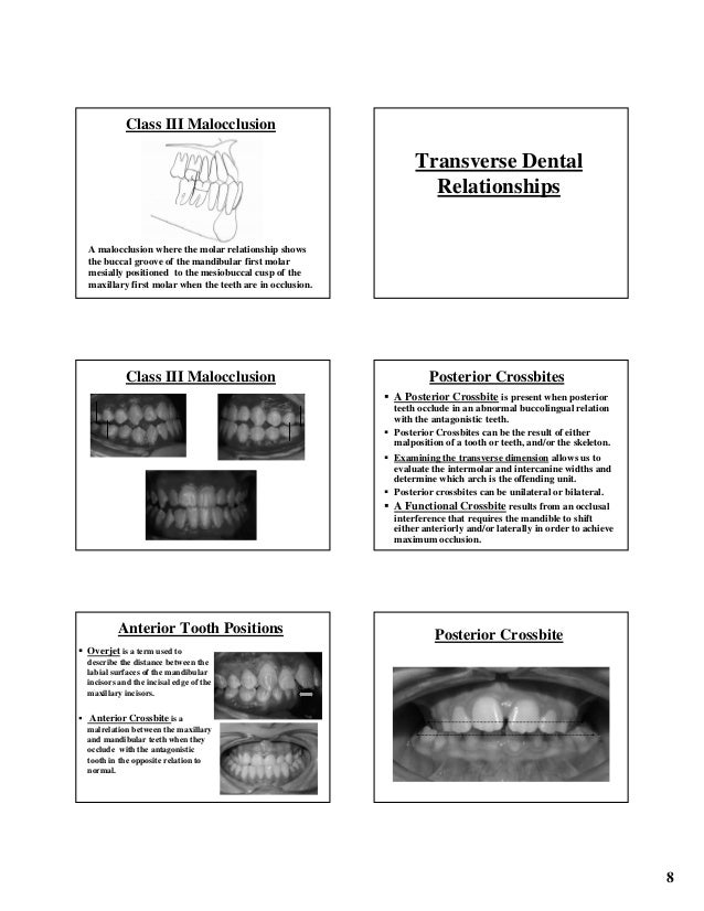 Angle's classification of malocclusion