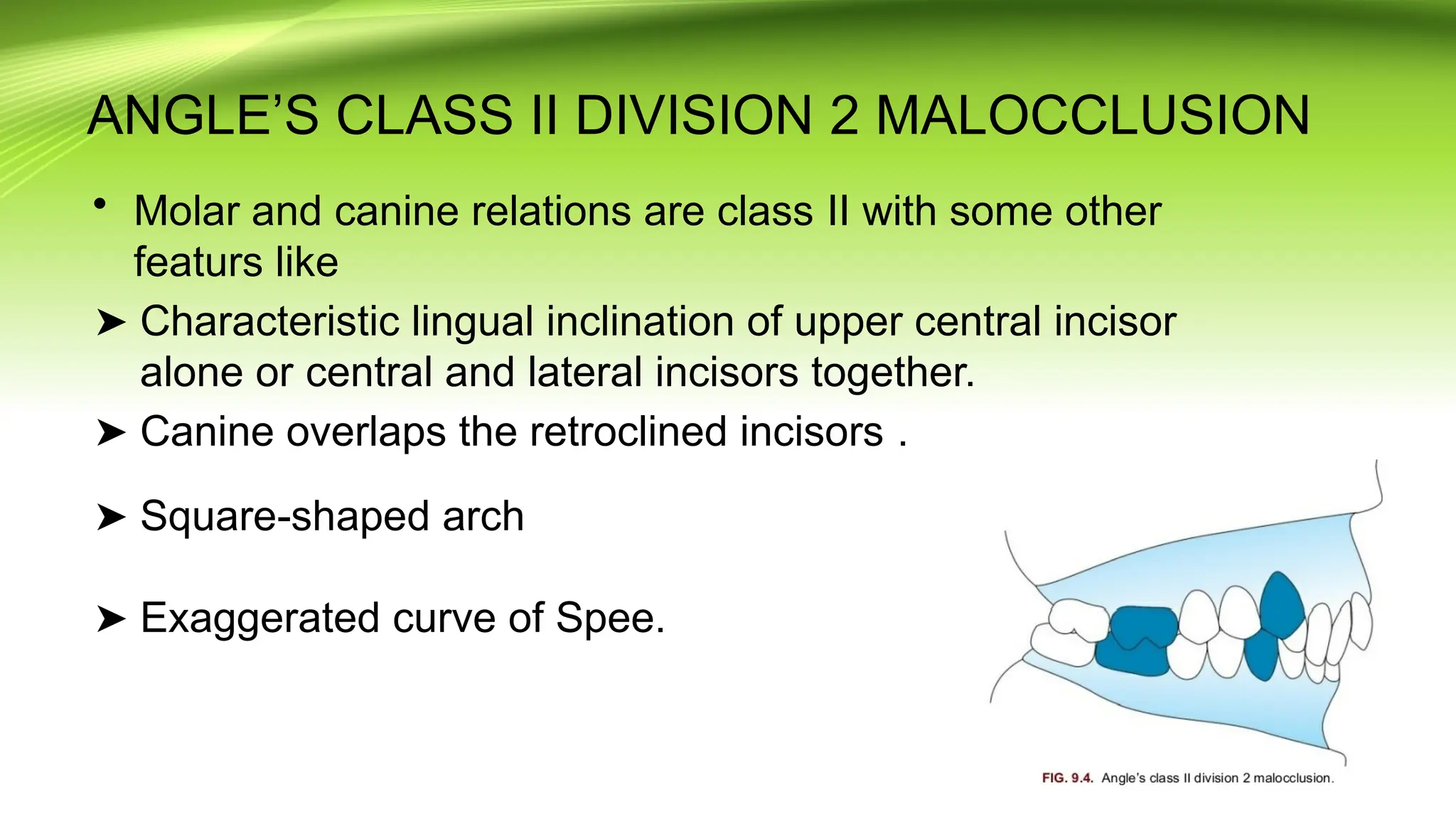 Angle’s classification of malocclusion. (2).pptx