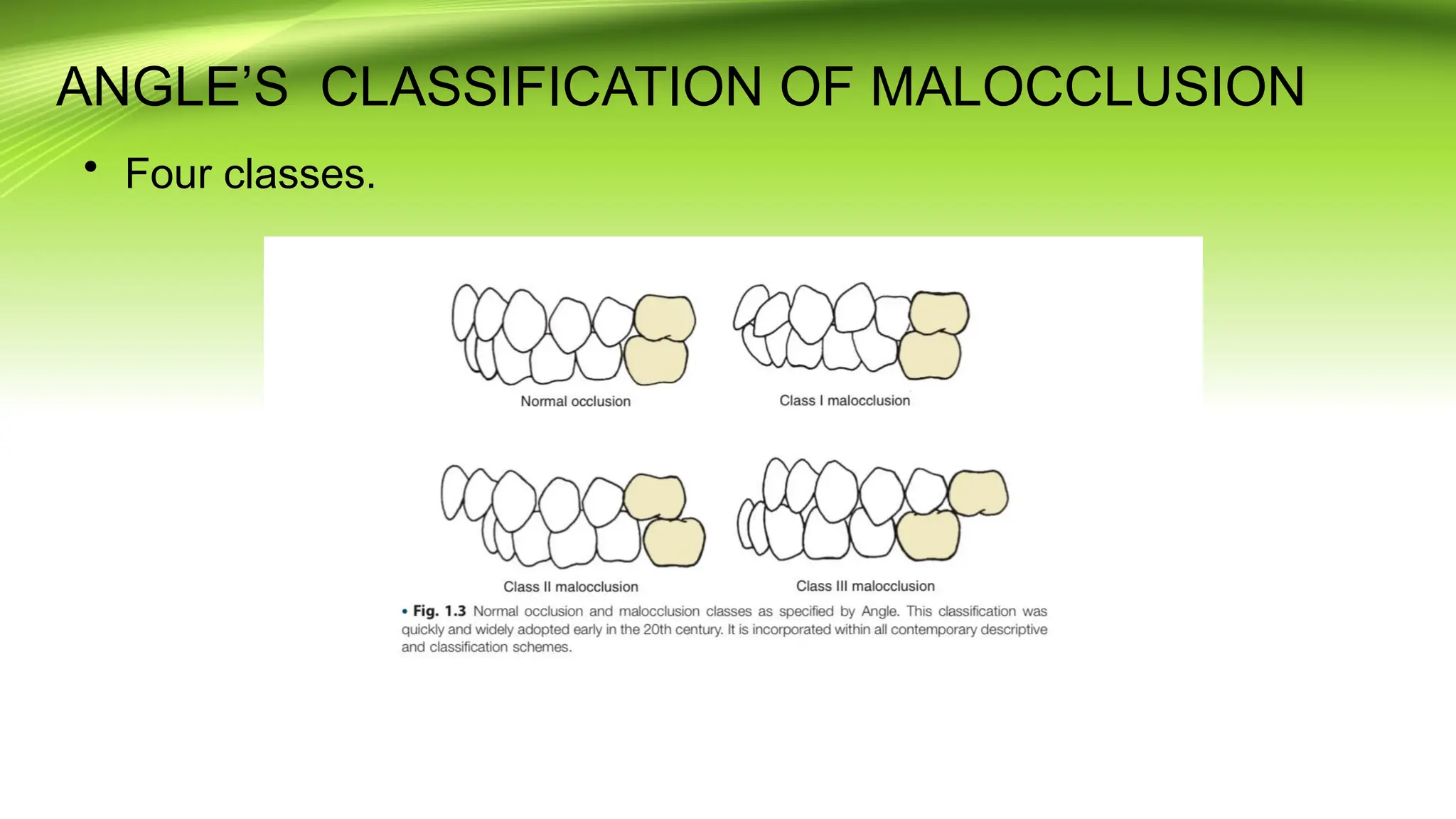 Angle’s classification of malocclusion. (2).pptx