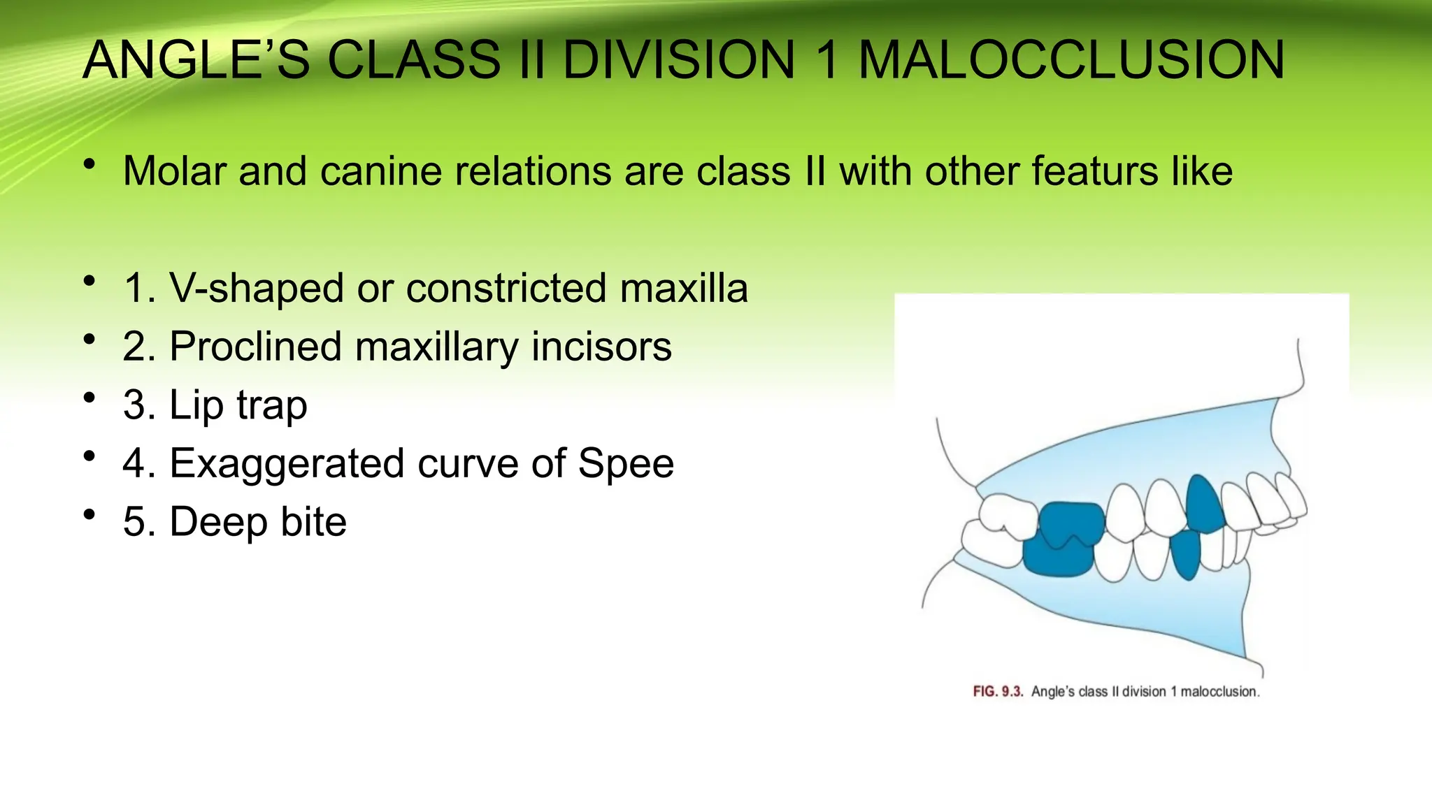 Angle’s classification of malocclusion. (2).pptx