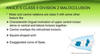 Angle’s classification of malocclusion. (2).pptx
