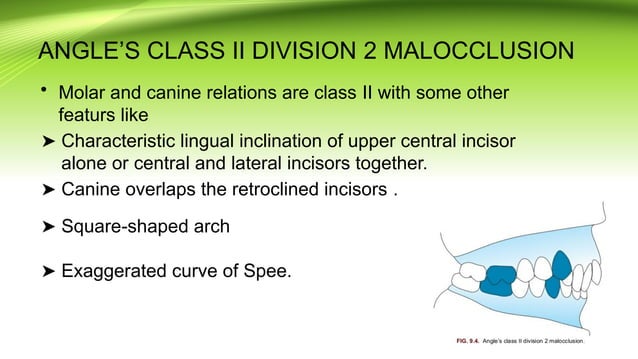 Angle’s classification of malocclusion. (2).pptx