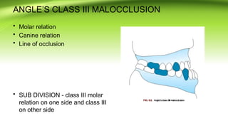 Angle’s classification of malocclusion. (2).pptx