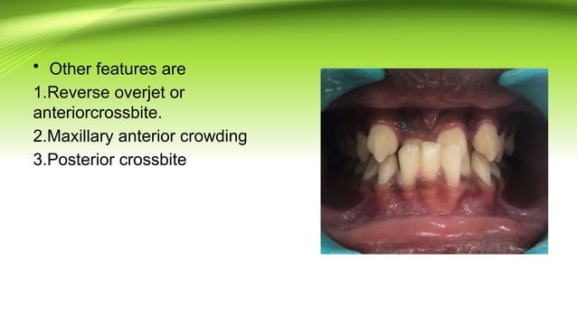 Angle’s classification of malocclusion. (2).pptx