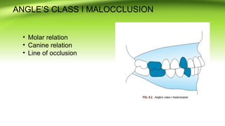 Angle’s classification of malocclusion. (2).pptx