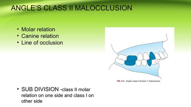 Angle’s classification of malocclusion. (2).pptx