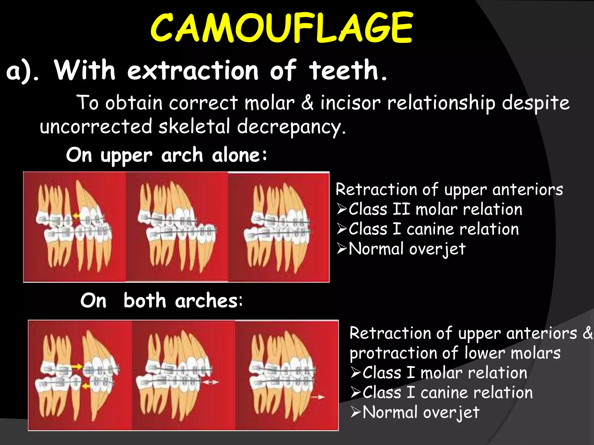 Angle’s class ii malocclusion | PPTX