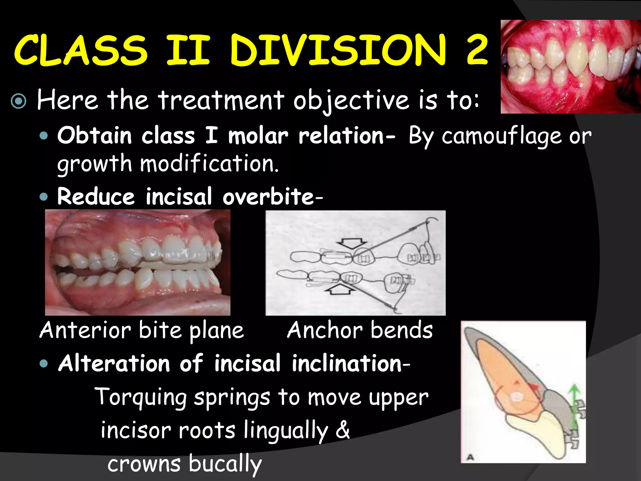 Angle’s class ii malocclusion | PPTX