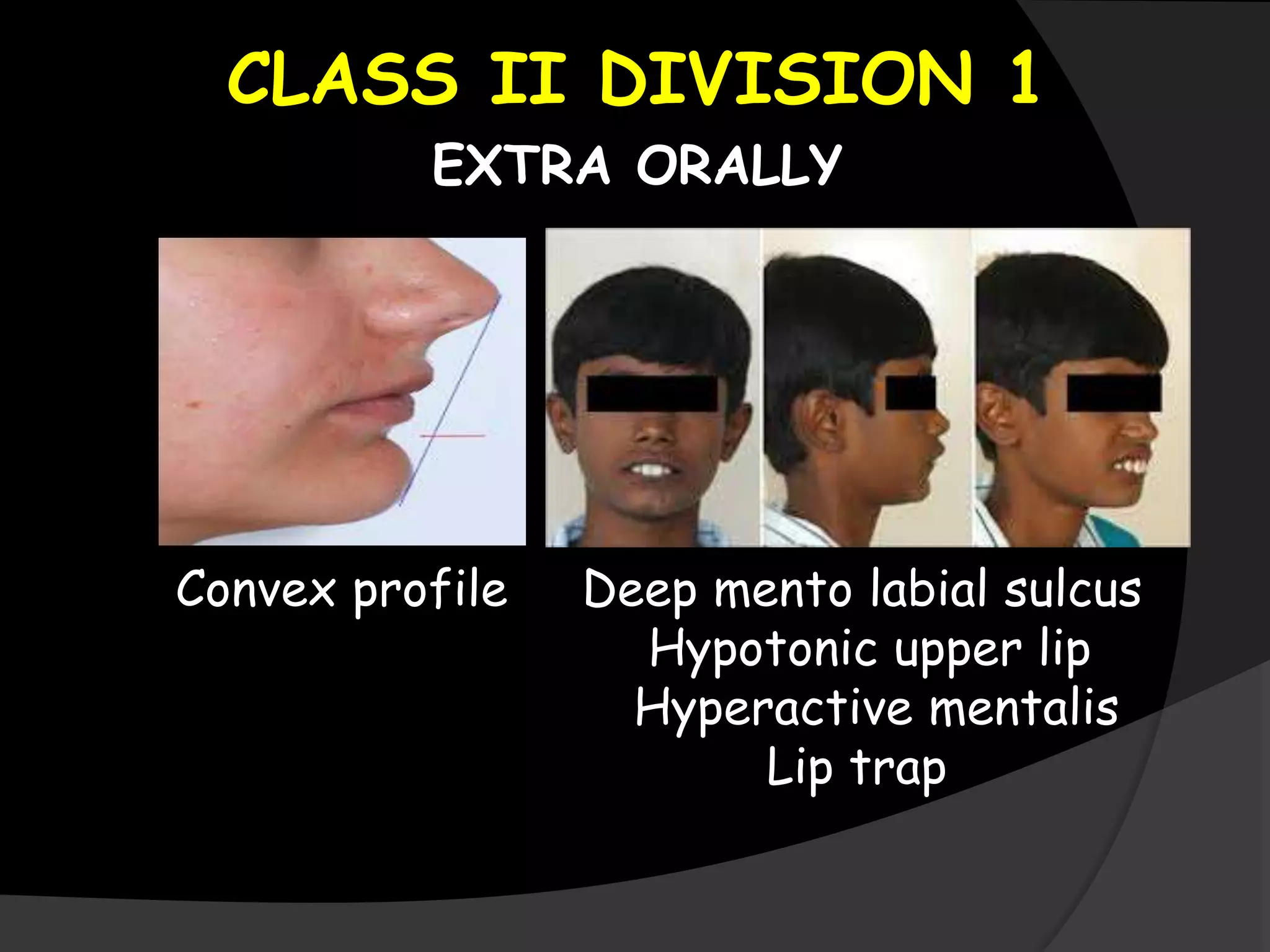 Angle’s class ii malocclusion | PPTX