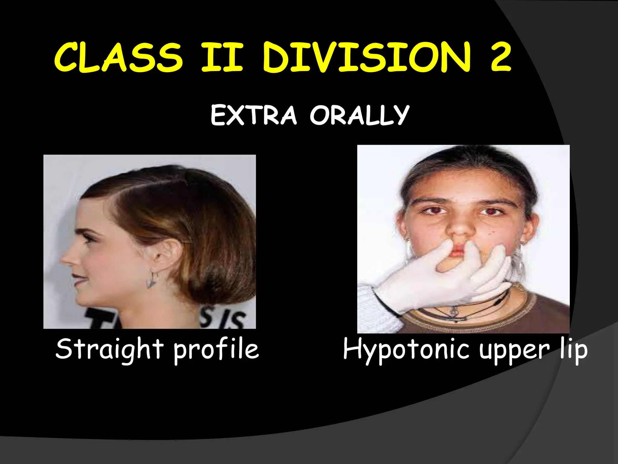 Angle’s class ii malocclusion | PPTX