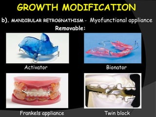 Angle’s class ii malocclusion | PPTX