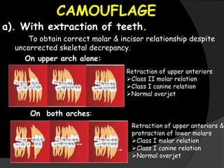 Angle’s class ii malocclusion | PPTX