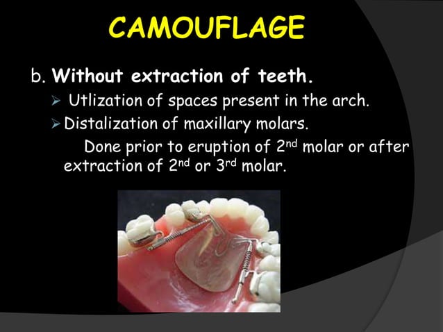 Angle’s class ii malocclusion | PPT