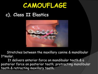 Angle’s class ii malocclusion | PPTX