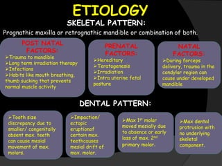 Angle’s class ii malocclusion | PPT