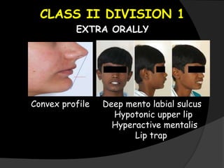 Angle’s class ii malocclusion | PPTX