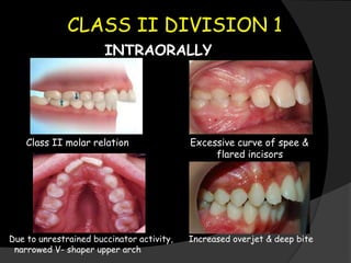 Angle’s class ii malocclusion | PPTX