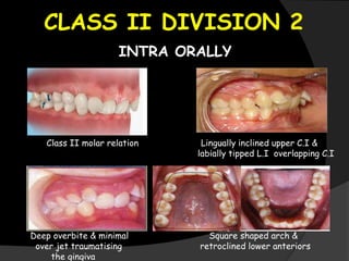 Angle’s class ii malocclusion | PPT