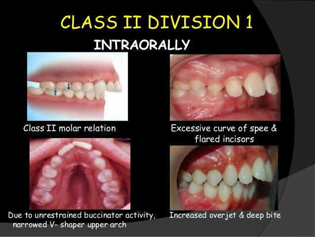 Angle’s class ii malocclusion