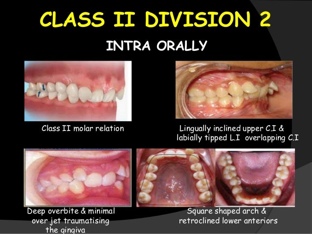 Angle’s class ii malocclusion