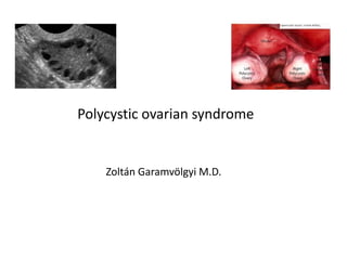PCOS | PDF