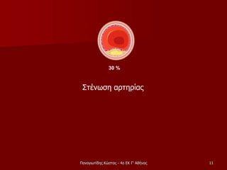 ΟΞΥ ΚΑΡΔΙΑΚΟ ΝΟΣΗΜΑ: Η ΣΤΗΘΑΓΧΗ | PPTX