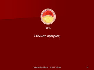 ΟΞΥ ΚΑΡΔΙΑΚΟ ΝΟΣΗΜΑ: Η ΣΤΗΘΑΓΧΗ | PPTX