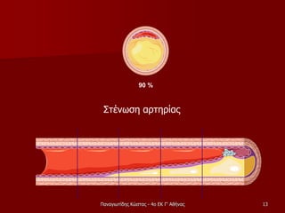 ΟΞΥ ΚΑΡΔΙΑΚΟ ΝΟΣΗΜΑ: Η ΣΤΗΘΑΓΧΗ | PPTX