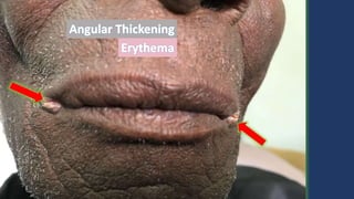 Angular cheilitis | Professional Dental E-Class | PPT