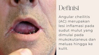 Angular Cheilitis laporan kasus PTT..... | PDF
