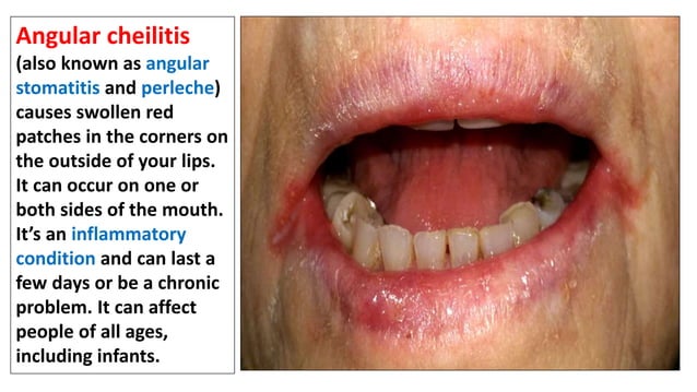 Angular chilitis | PPTX | Dental Health | Diseases and Conditions