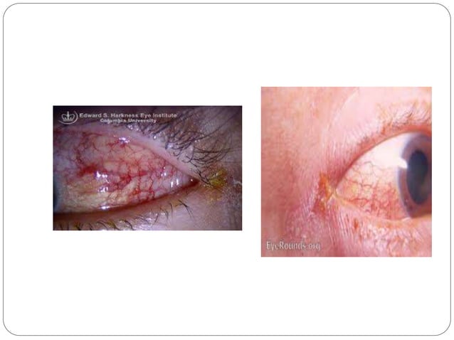 Angular conjunctivitis | PPTX | Eye and Vision Conditions | Diseases ...