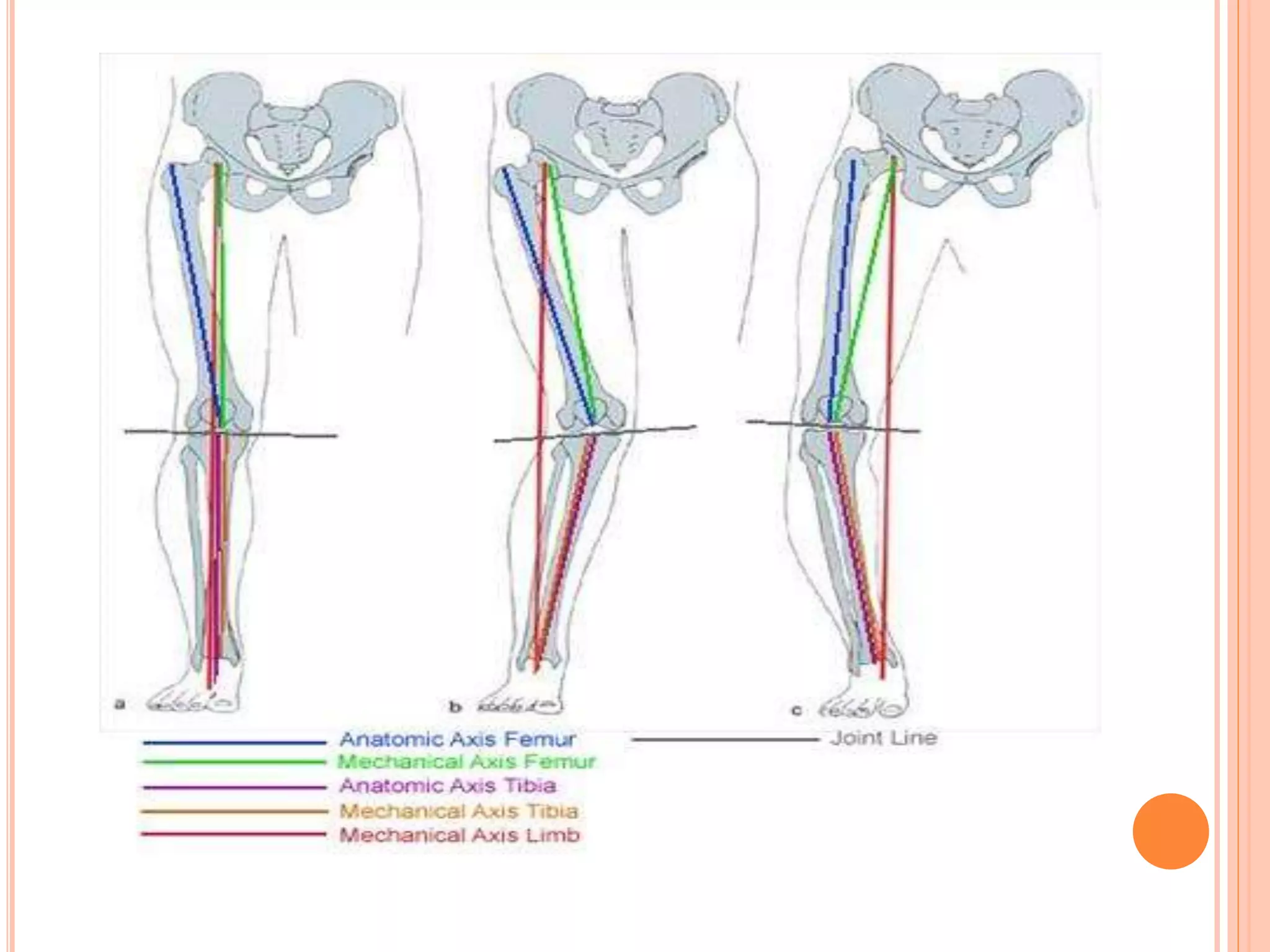 Angular deformities around the knee seminar | PPTX