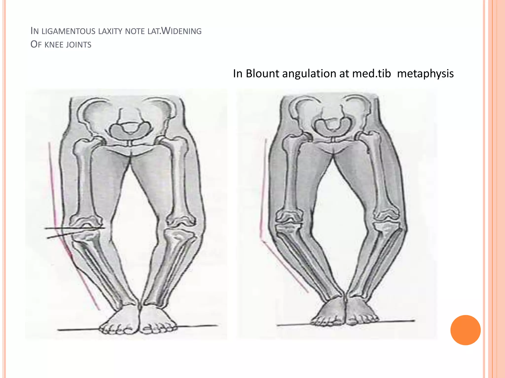 Angular deformities around the knee seminar | PPTX