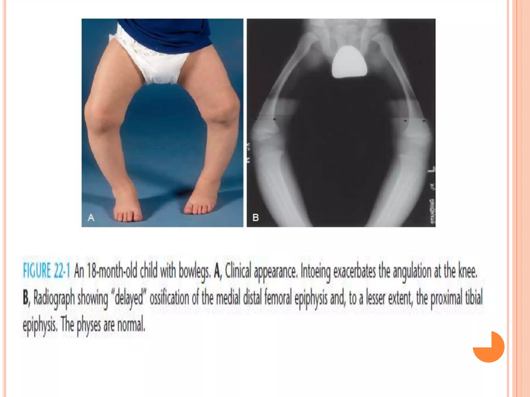 Angular deformities around the knee seminar | PPTX