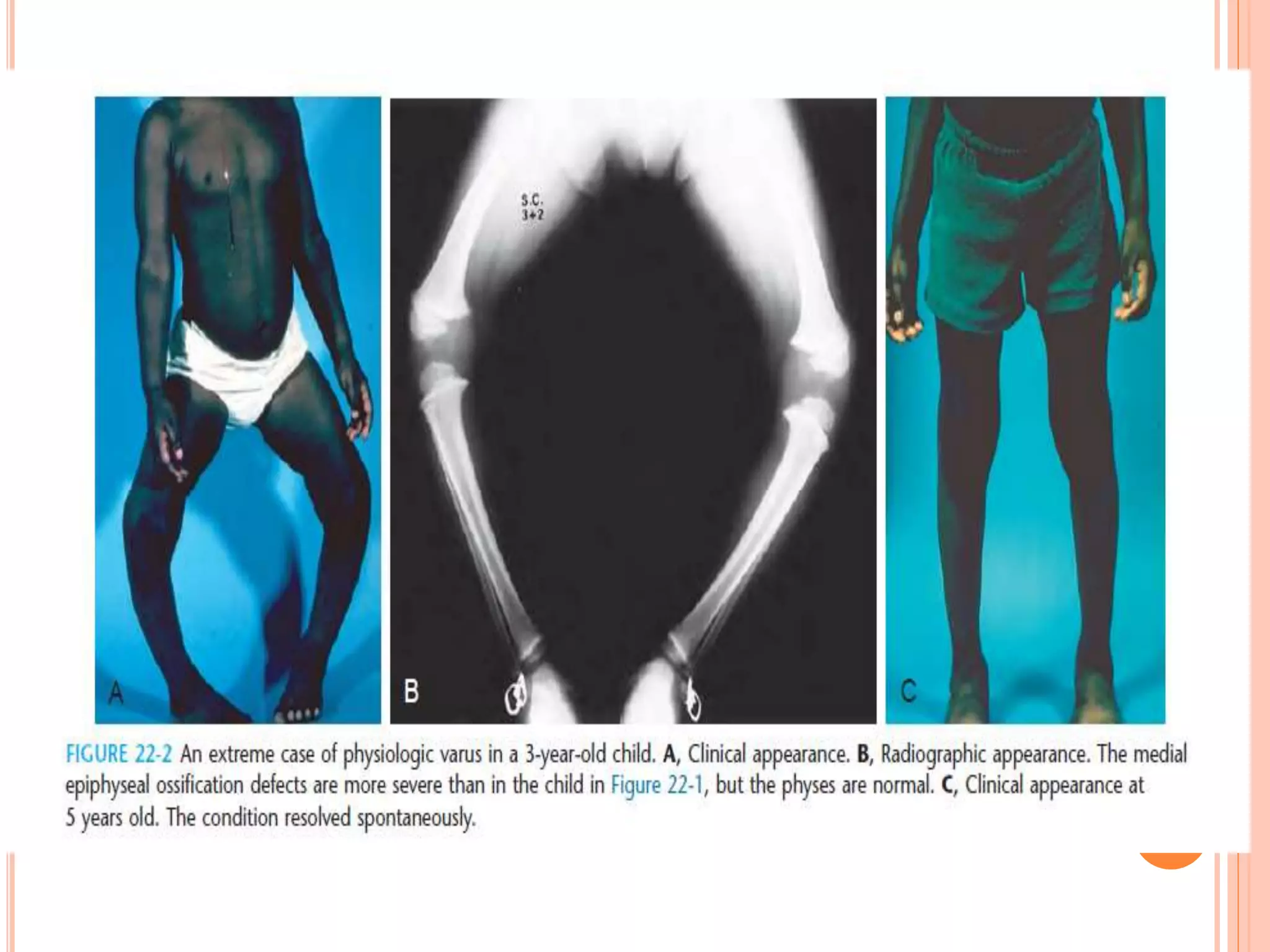 Angular deformities around the knee seminar | PPTX