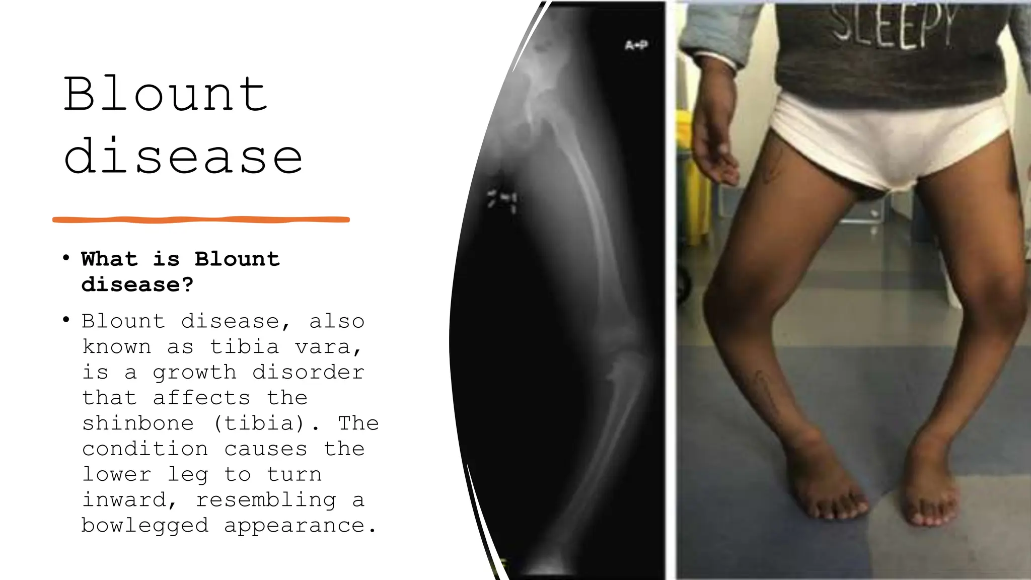 Angular deformities of the lower limp.pptx