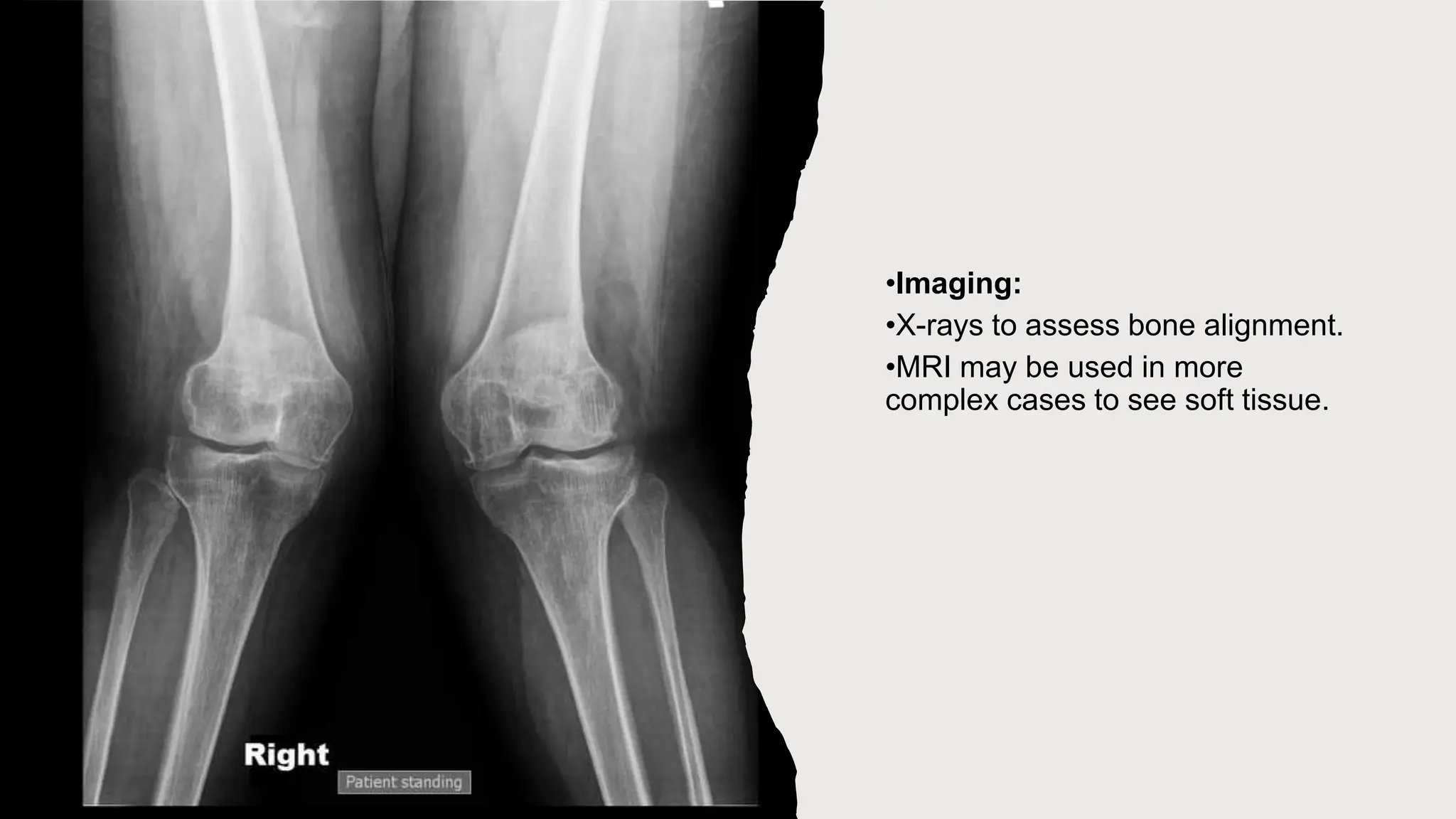 Angular deformities of the lower limp.pptx