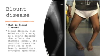 Angular deformities of the lower limp.pptx | Death, Injury, or Military ...