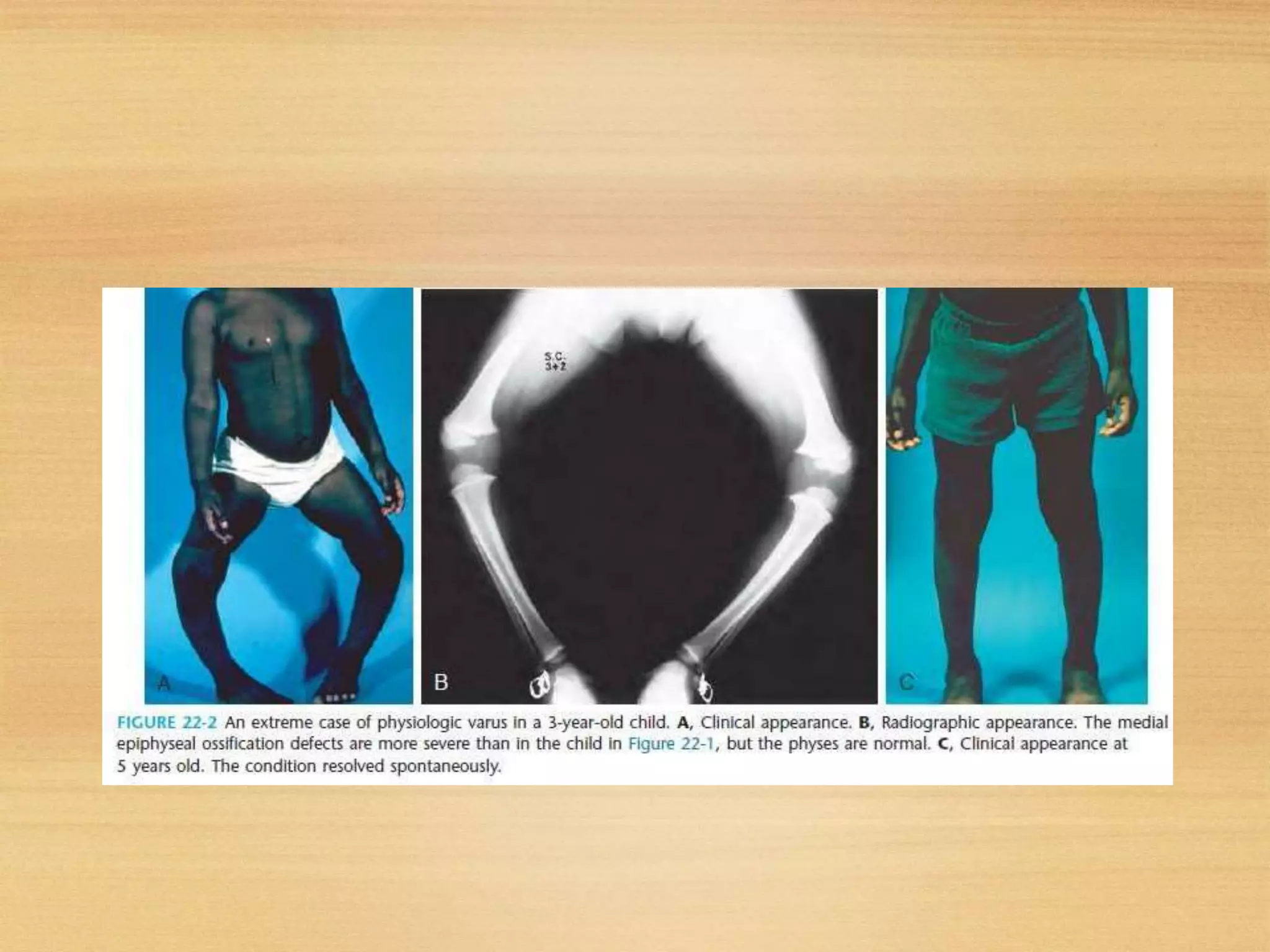 Angular Deformity | PPTX