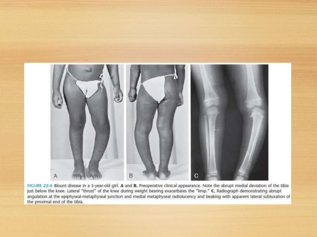 Angular Deformity | PPTX | Death, Injury, or Military Conflict | Sensitive Topics