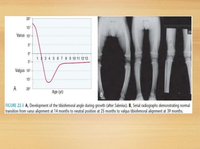 Angular Deformity | PPTX | Death, Injury, or Military Conflict ...
