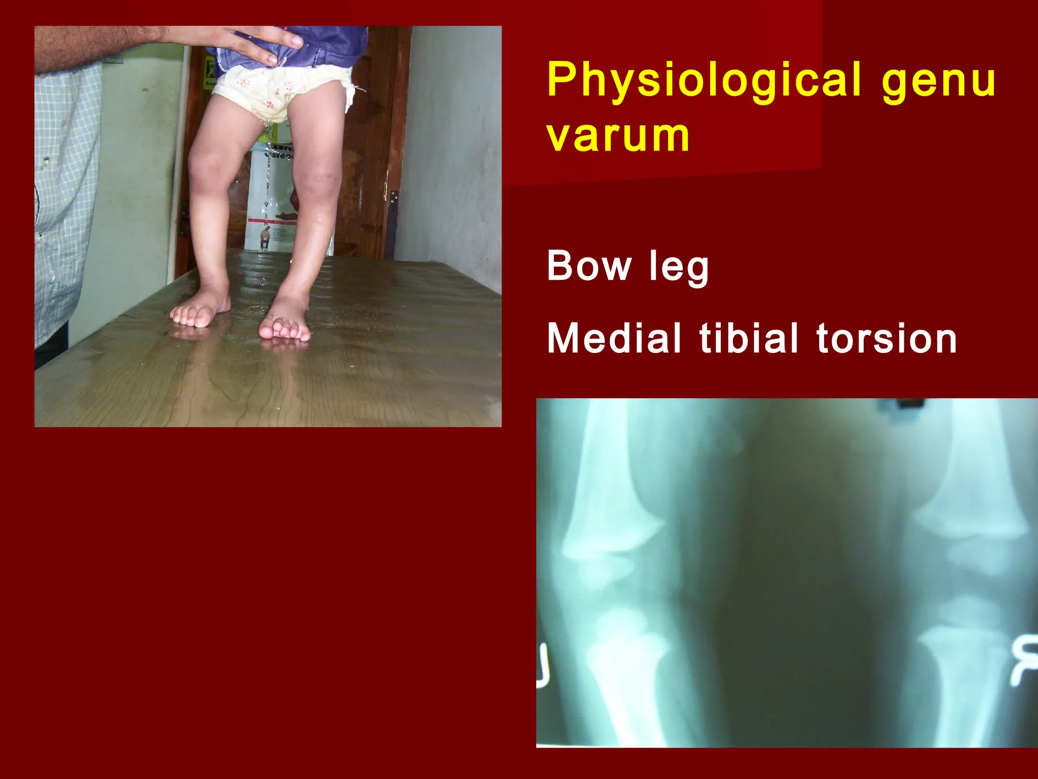 Angular & torsional deformities of the lower limb | PPT